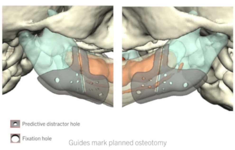 Mandibular Distraction Osteogenesis (Pierre Robin and Sleep Apnea) | Iowa Head and Neck ...